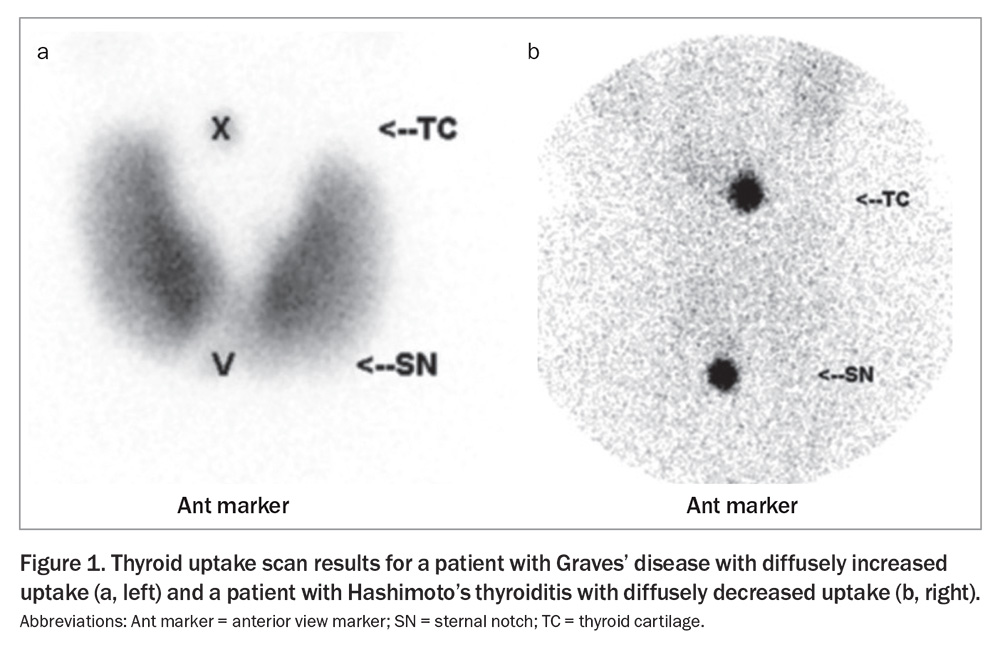 Differentiating Hashimoto’s thyroiditis and Graves’ disease: a ...