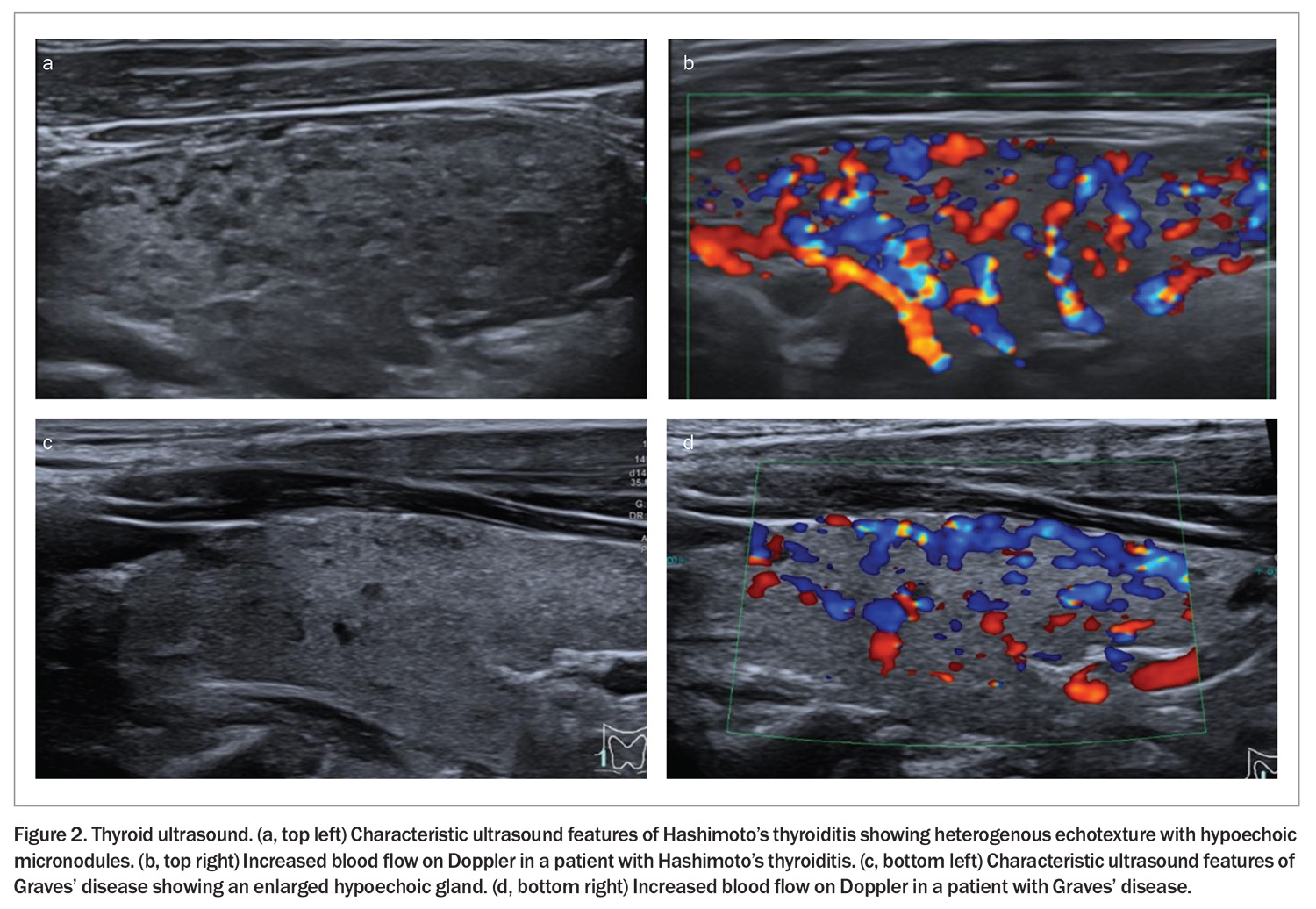 Differentiating Hashimoto’s thyroiditis and Graves’ disease: a ...